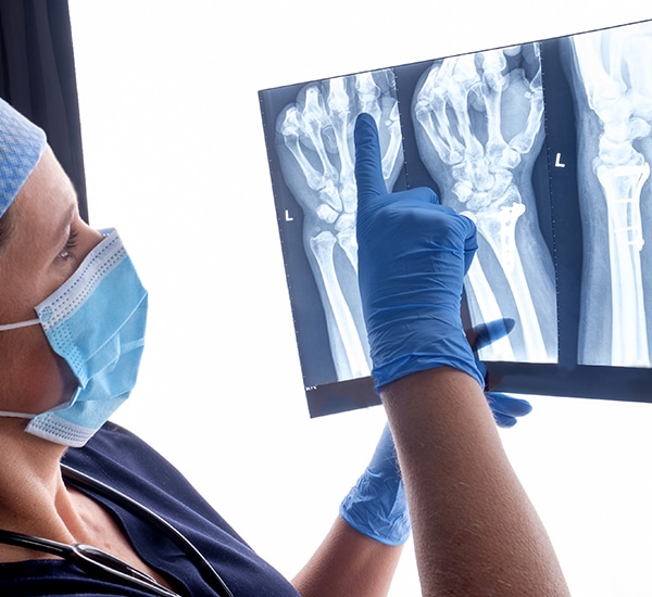 Broken Bone & Fracture Lawyer